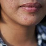 Acne in Adults Can Bring Stigma at Work and Socially - LadyLively